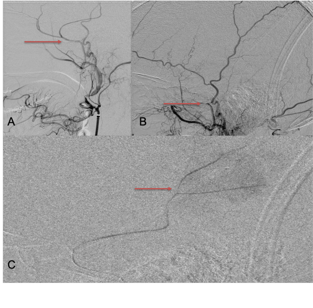 Middle Meningeal Artery Embolization of Bilateral Subacute Subdural ...