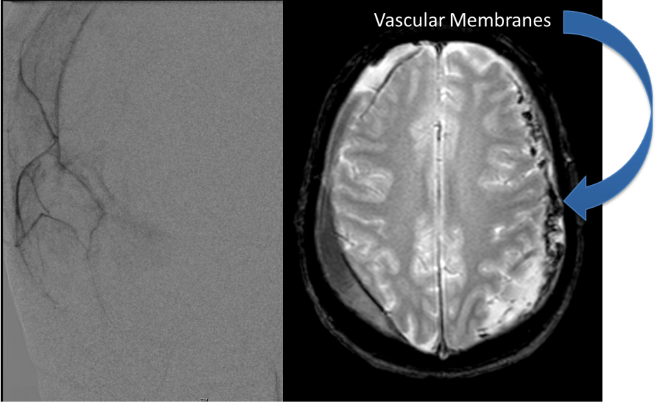Middle Meningeal Artery Embolization of Bilateral Subacute Subdural Hematomas | NSPC Brain ...